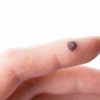 Lump Diagnosis & Treatment | Push Doctor